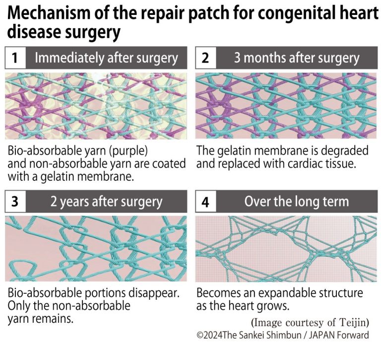 Breakthrough in Heart Surgery: New Repair Patch Offers Hope for ...