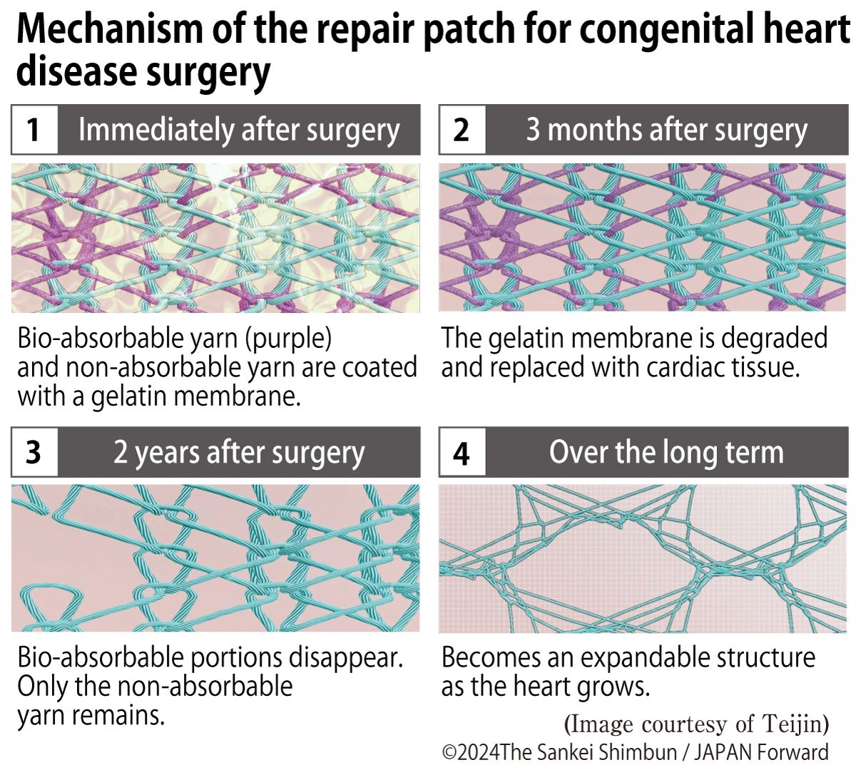 Breakthrough in Heart Surgery: New Repair Patch Offers Hope for ...